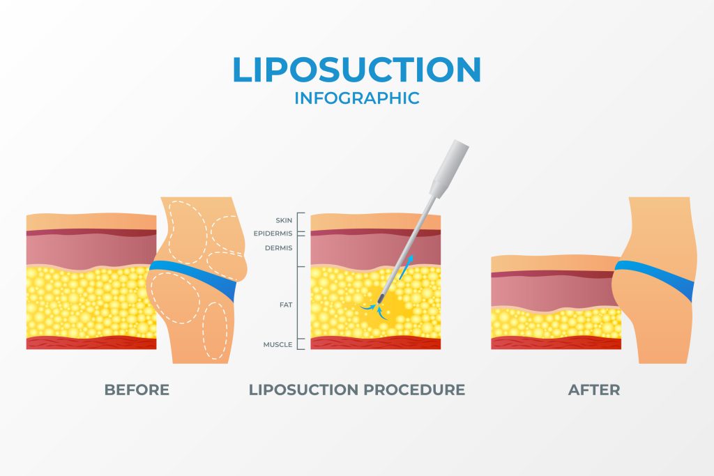 LIPOSUCTION - بیمارستان بین المللی و فوق تخصصی حکیم